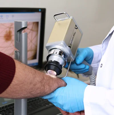 Mole Screening and Digital Mole Mapping - healthbayaesthetics